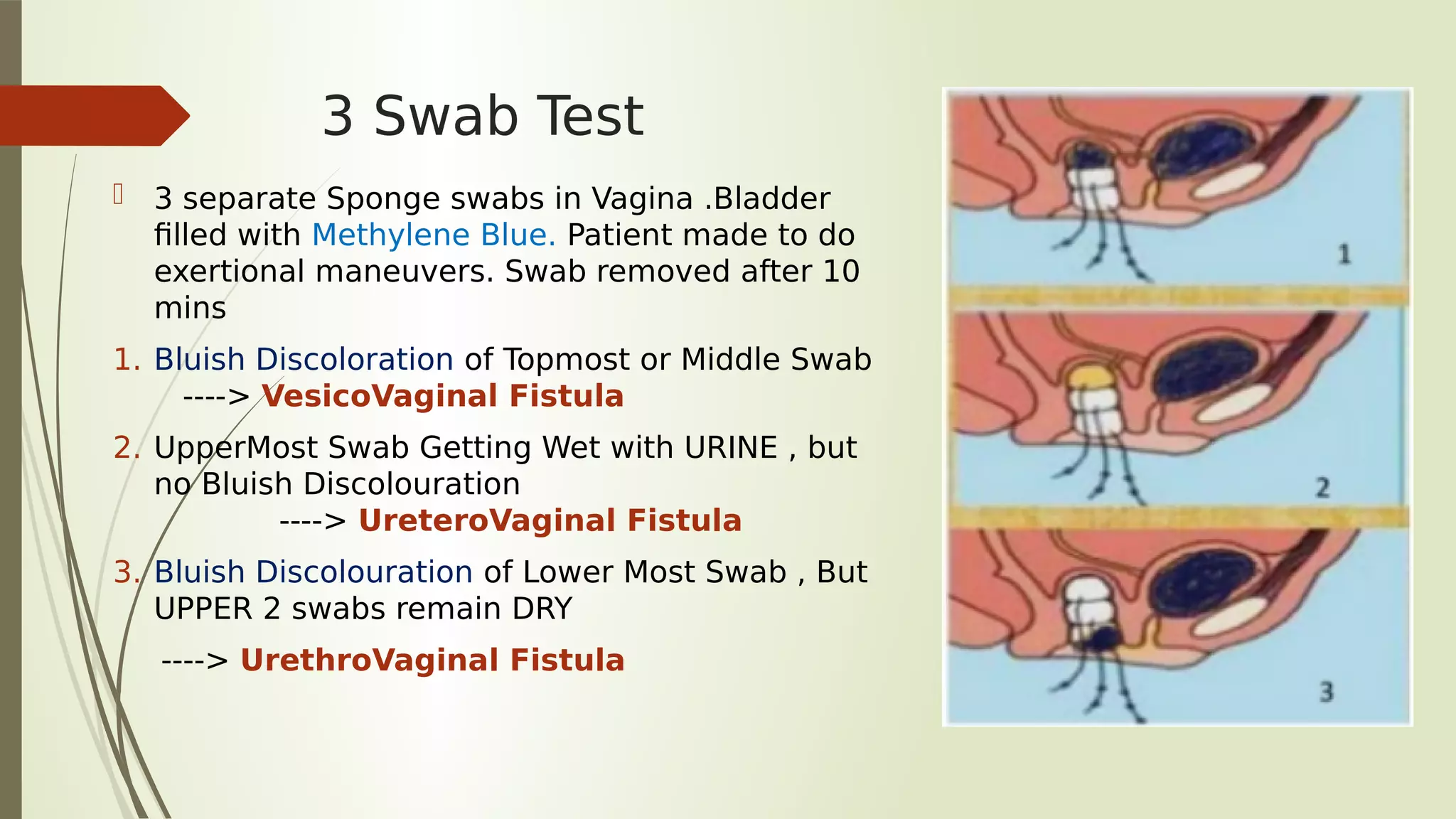 Urinary Tract Fistulas -(VVF) Etiology, Diagnosis, Management | PDF