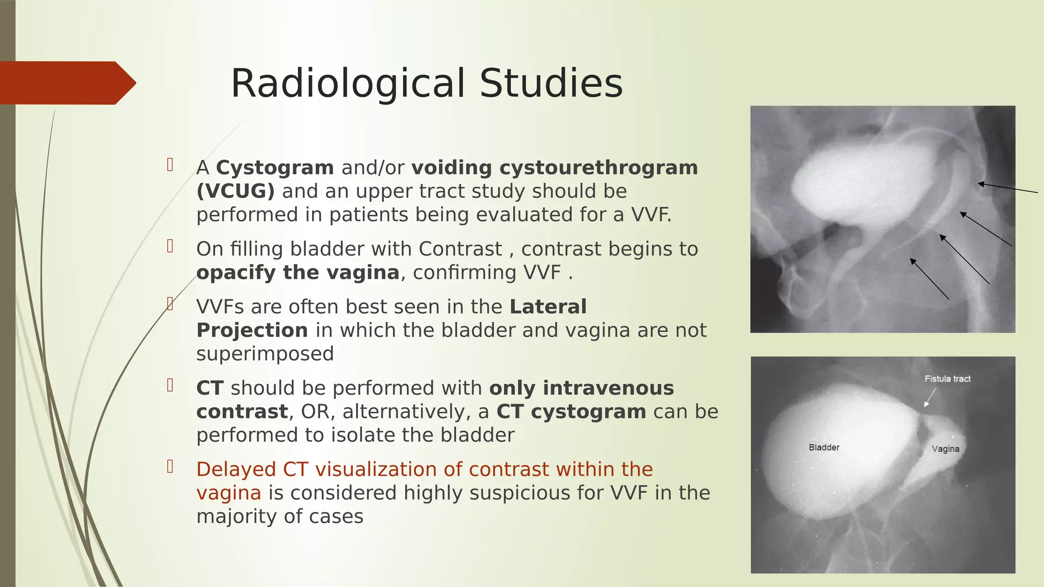 Urinary Tract Fistulas -(VVF) Etiology, Diagnosis, Management | PDF