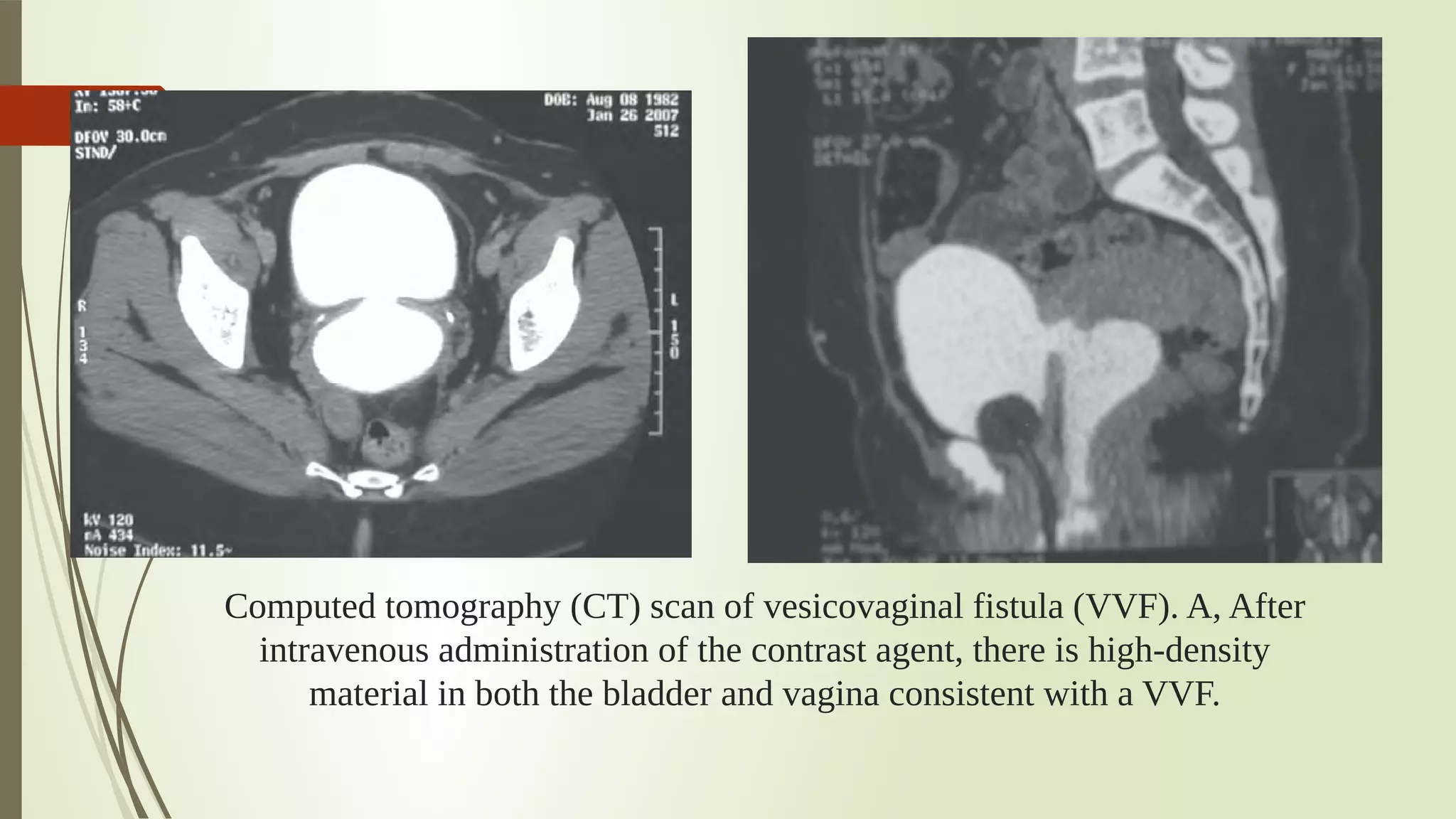 Urinary Tract Fistulas -(VVF) Etiology, Diagnosis, Management | PDF