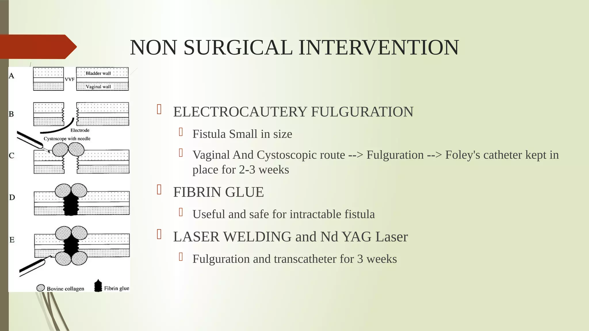Urinary Tract Fistulas -(VVF) Etiology, Diagnosis, Management | PDF