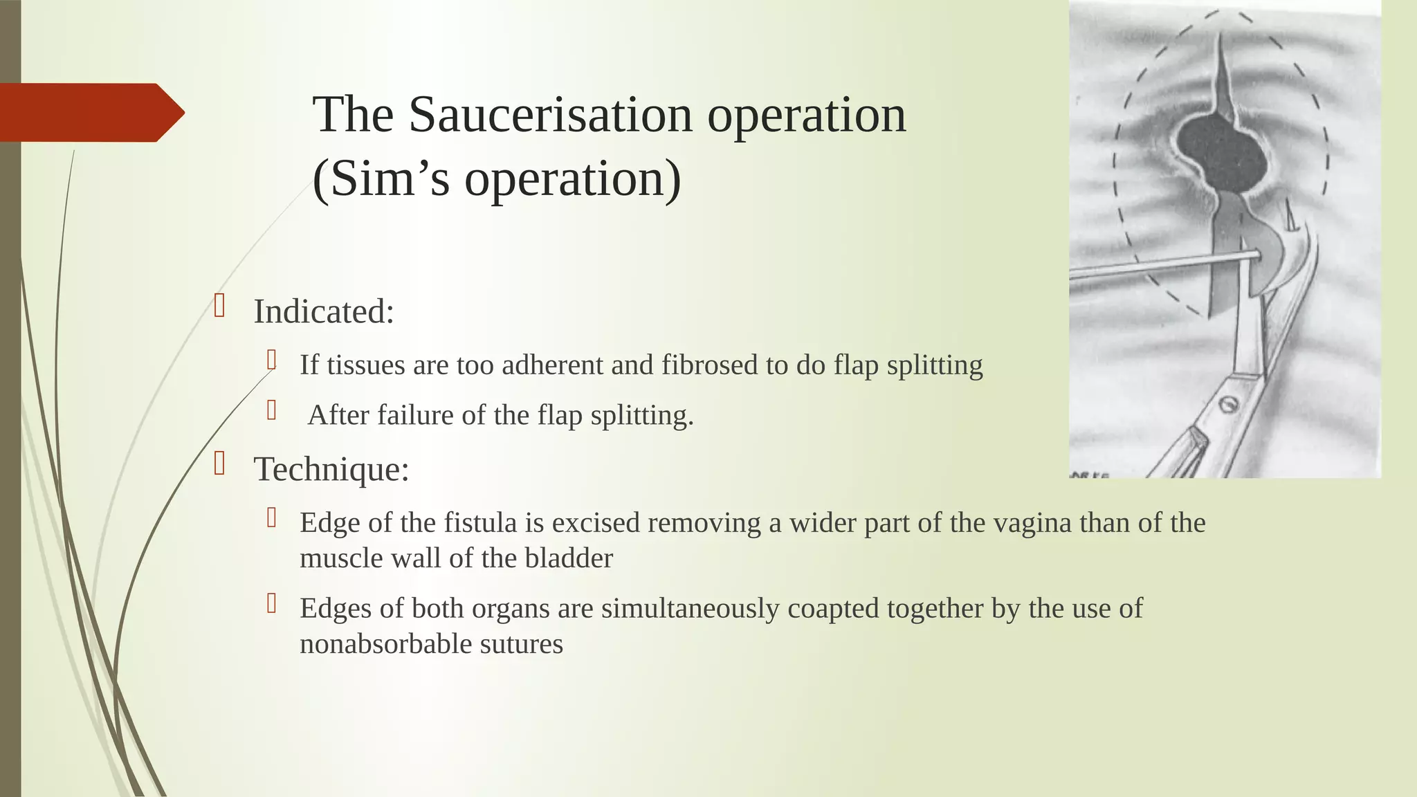 Urinary Tract Fistulas -(VVF) Etiology, Diagnosis, Management | PDF