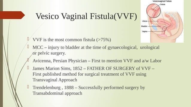 Urinary Tract Fistulas -(VVF) Etiology, Diagnosis, Management | PDF | Sexual Conditions | Sexual ...