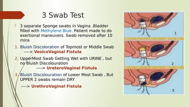 Urinary Tract Fistulas -(VVF) Etiology, Diagnosis, Management | PDF ...