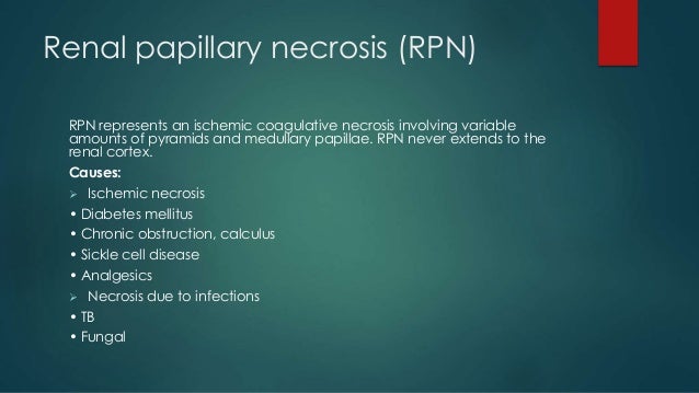 Renal Papillary Necrosis Ring Sign Renal Papillary Necrosis Unmasking