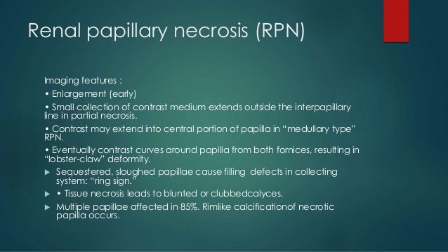 Renal Papillary Necrosis Ring Sign Renal Papillary Necrosis Unmasking