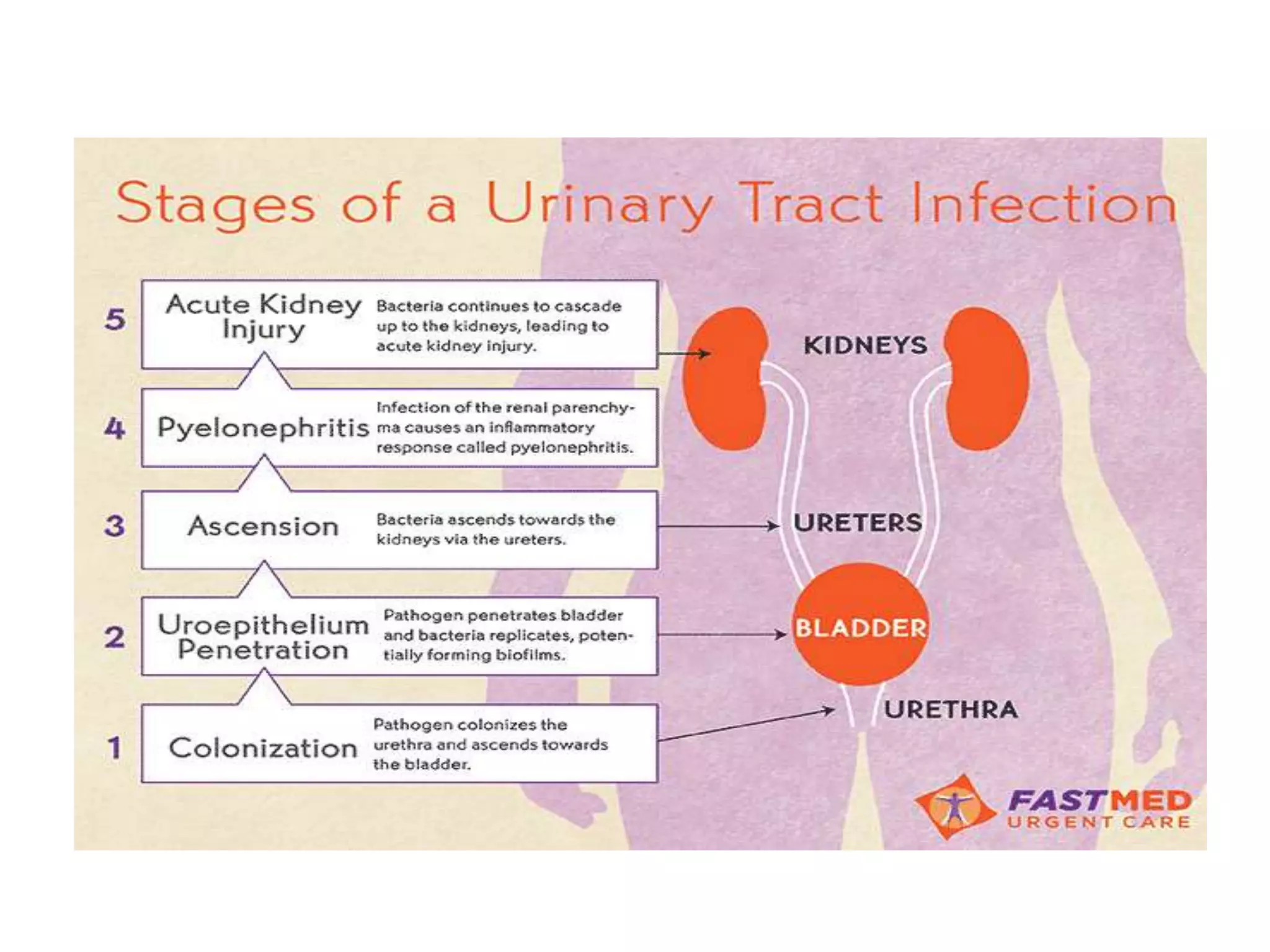 Urinary tract infection | PPTX