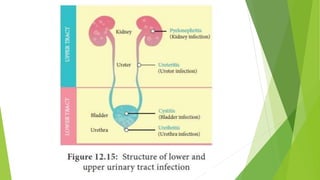 Urinary tract infection | PPT