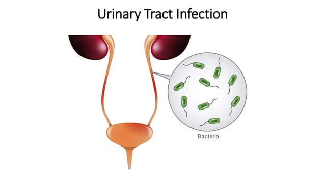 Ayurvedic Treatment for UTI | PPT