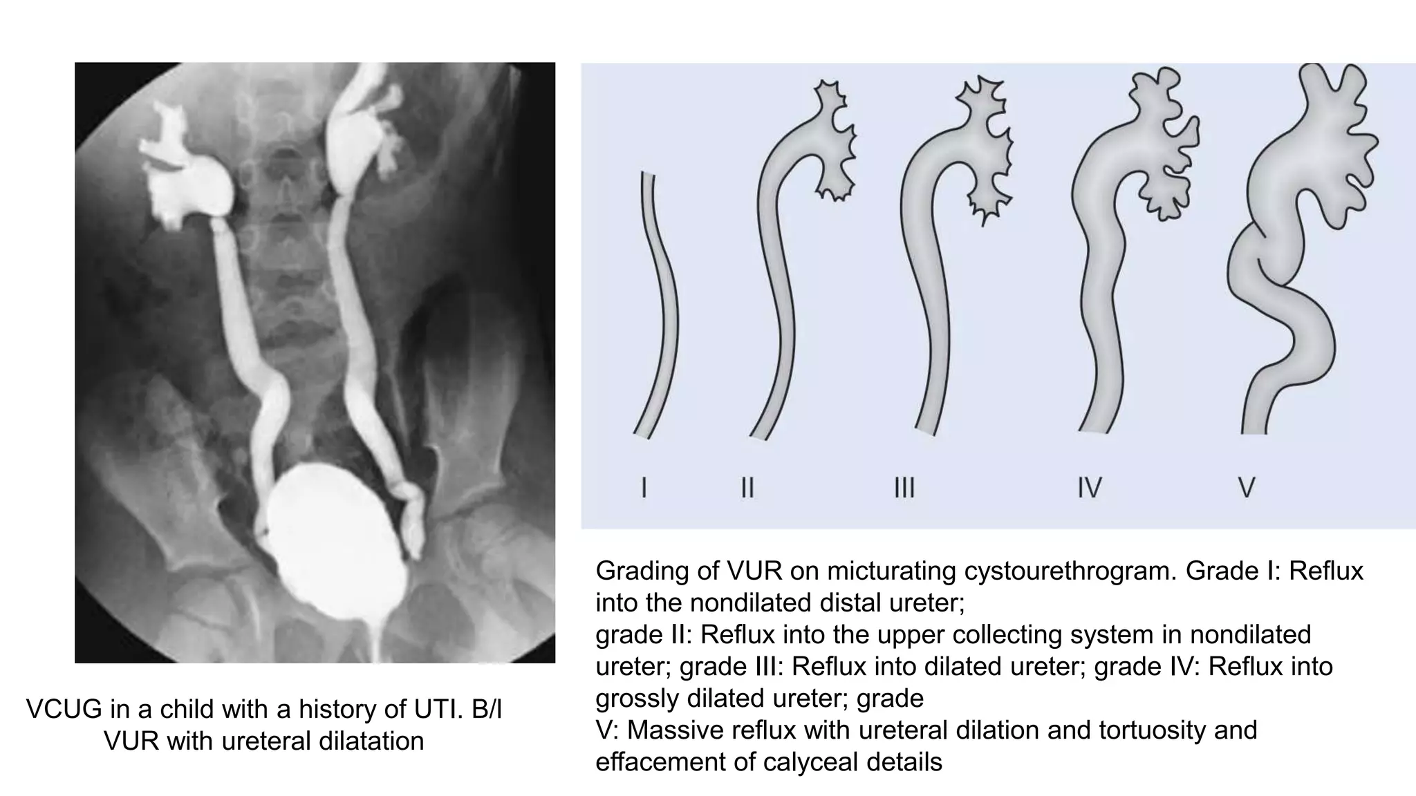 Urinary tract infection in children | PPTX