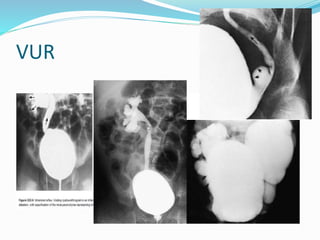 URINARY TRACT INFECTION IN CHILDREN 2.pptx