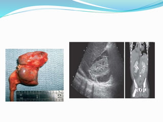 URINARY TRACT INFECTION IN CHILDREN 2.pptx