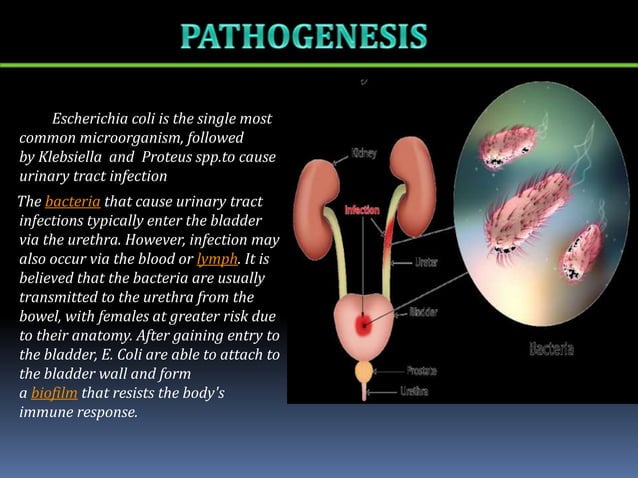 Urinary tract infection ppt