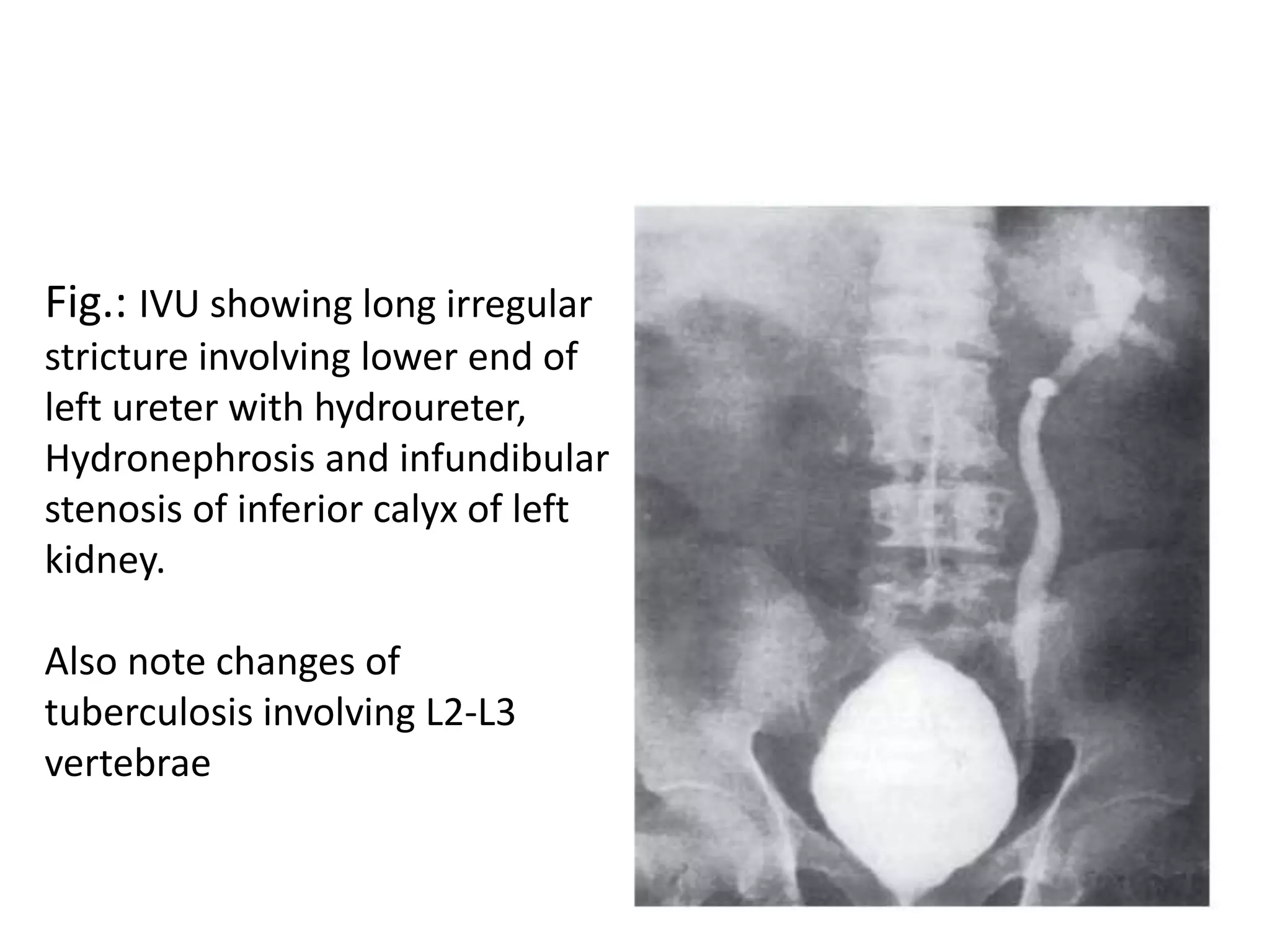 Urinary tract infections | PPTX