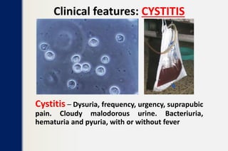 Urinary tract infections 2 | PPTX
