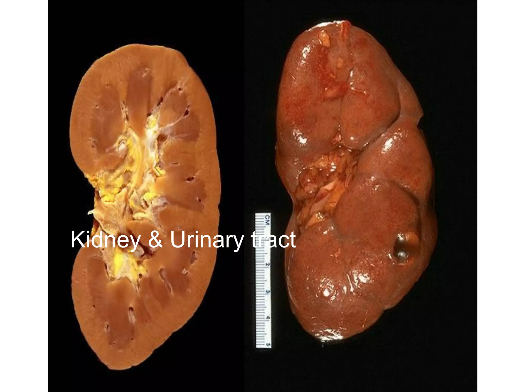 Urinary tract pathology lab | PDF