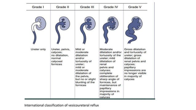 Urinary tracts infections in pediatrics (UTI) | PPTX | Digestive ...