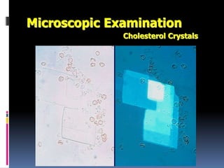 Cholesterol Crystals In Urine Polarized