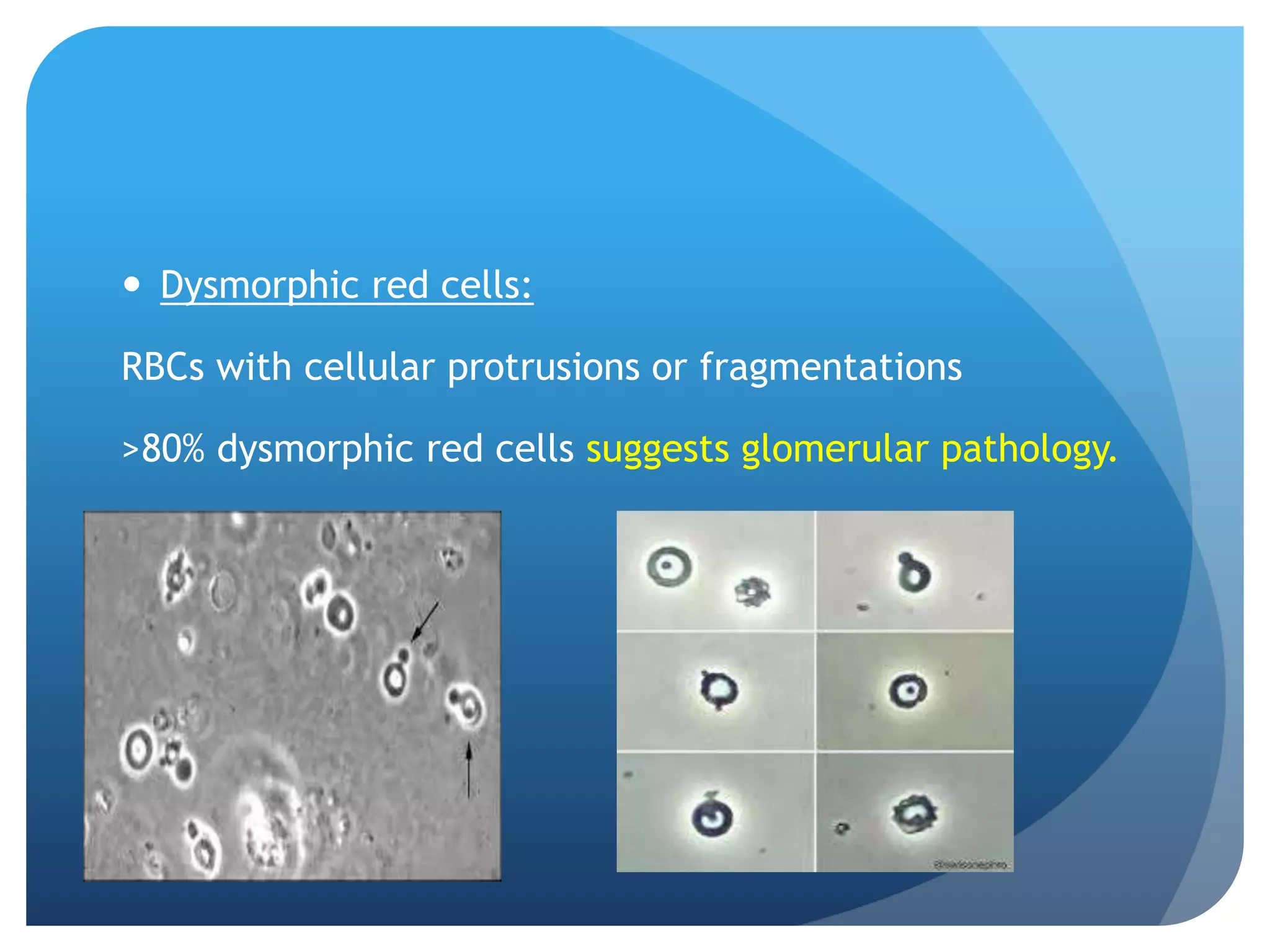 Urine analysis microscopic examination | PPTX