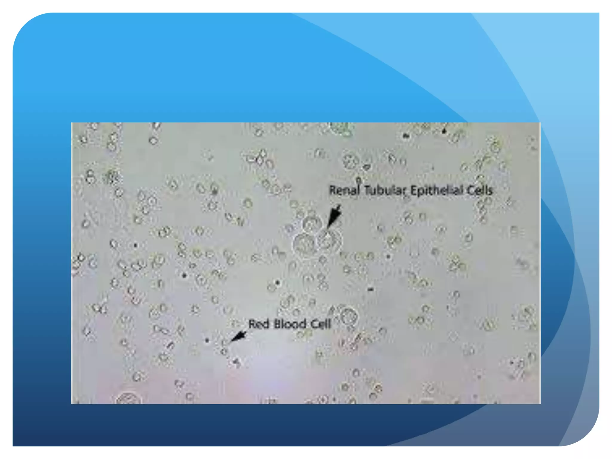 Urine analysis microscopic examination | PPTX
