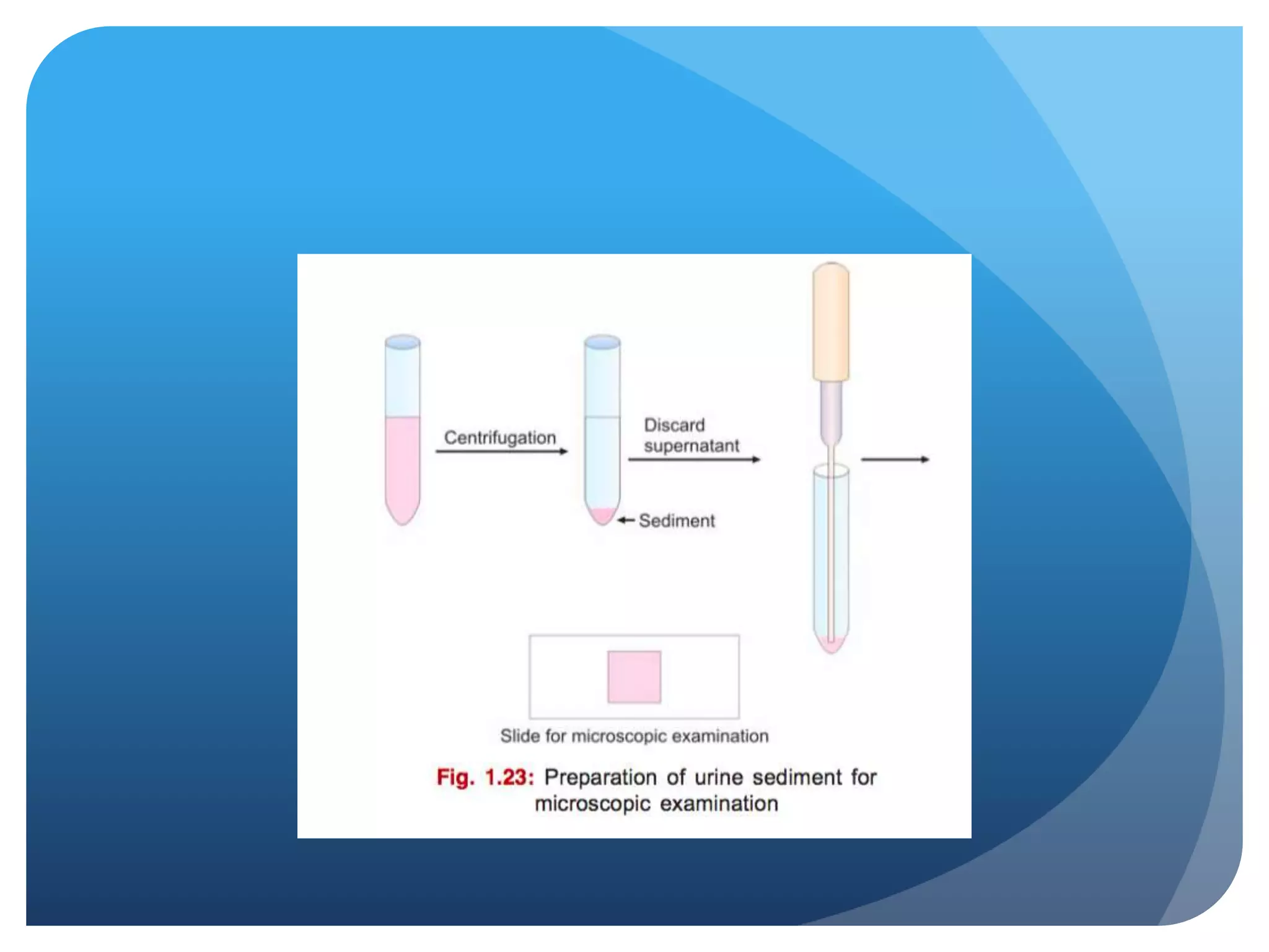 Urine analysis microscopic examination | PPTX