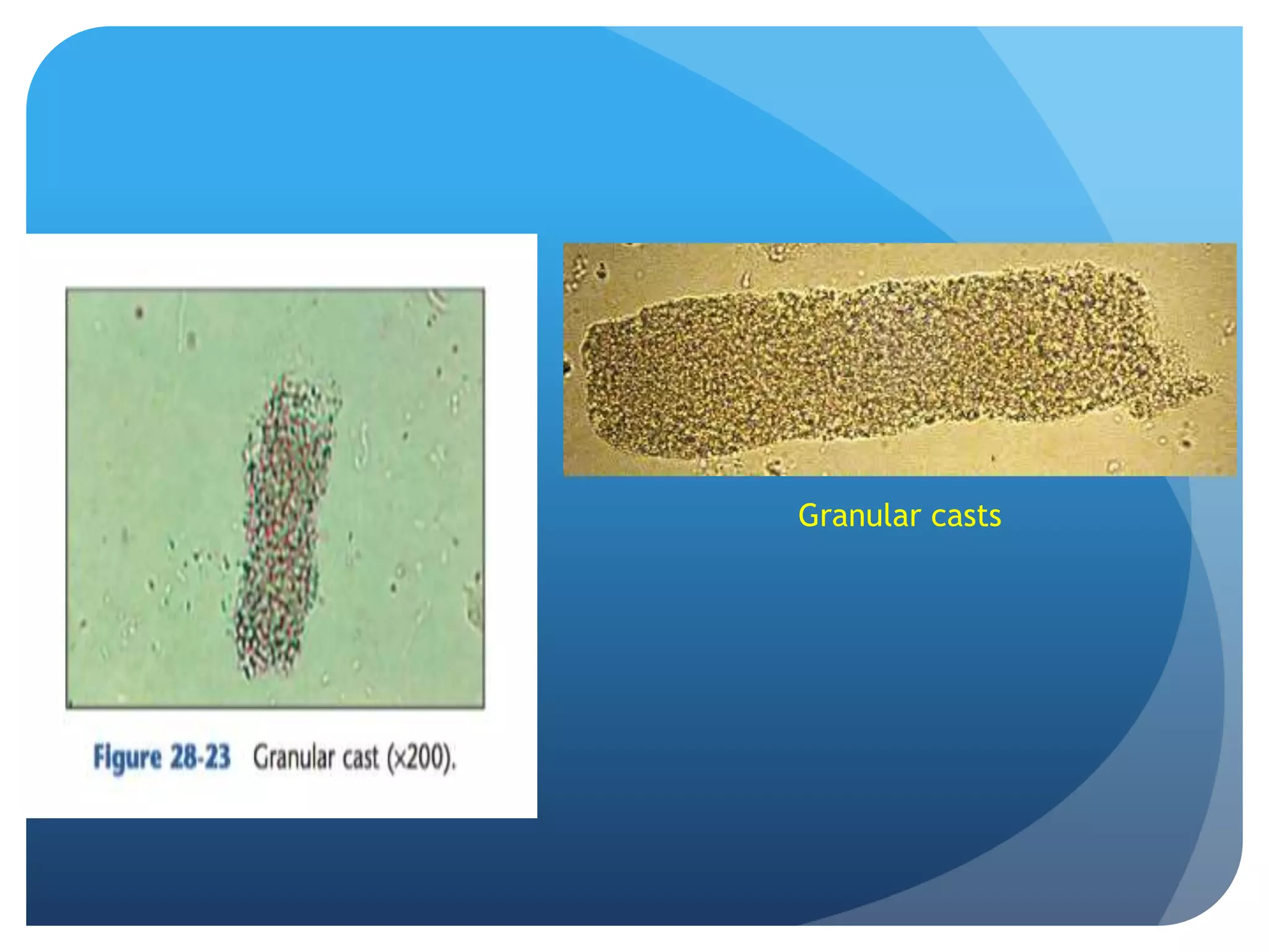 Urine analysis microscopic examination | PPTX