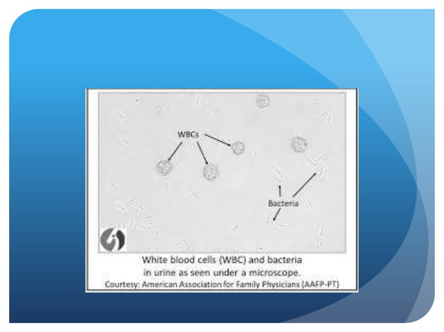 Urine analysis microscopic examination | PPTX