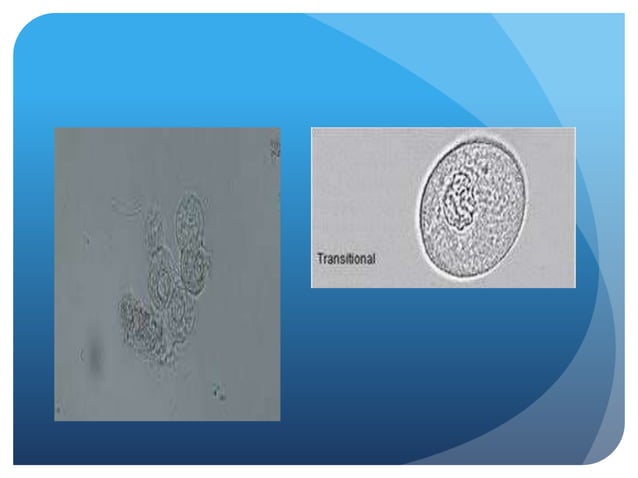 Urine analysis microscopic examination | PPTX