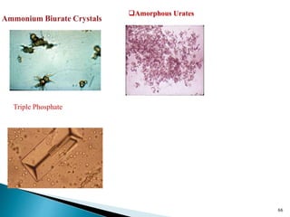 Ammonium Biurate In Urine