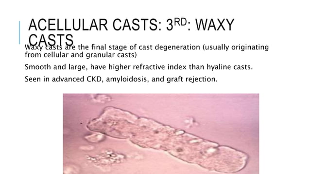 Urine casts | PPTX