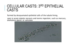 Cellular Cast In Urine
