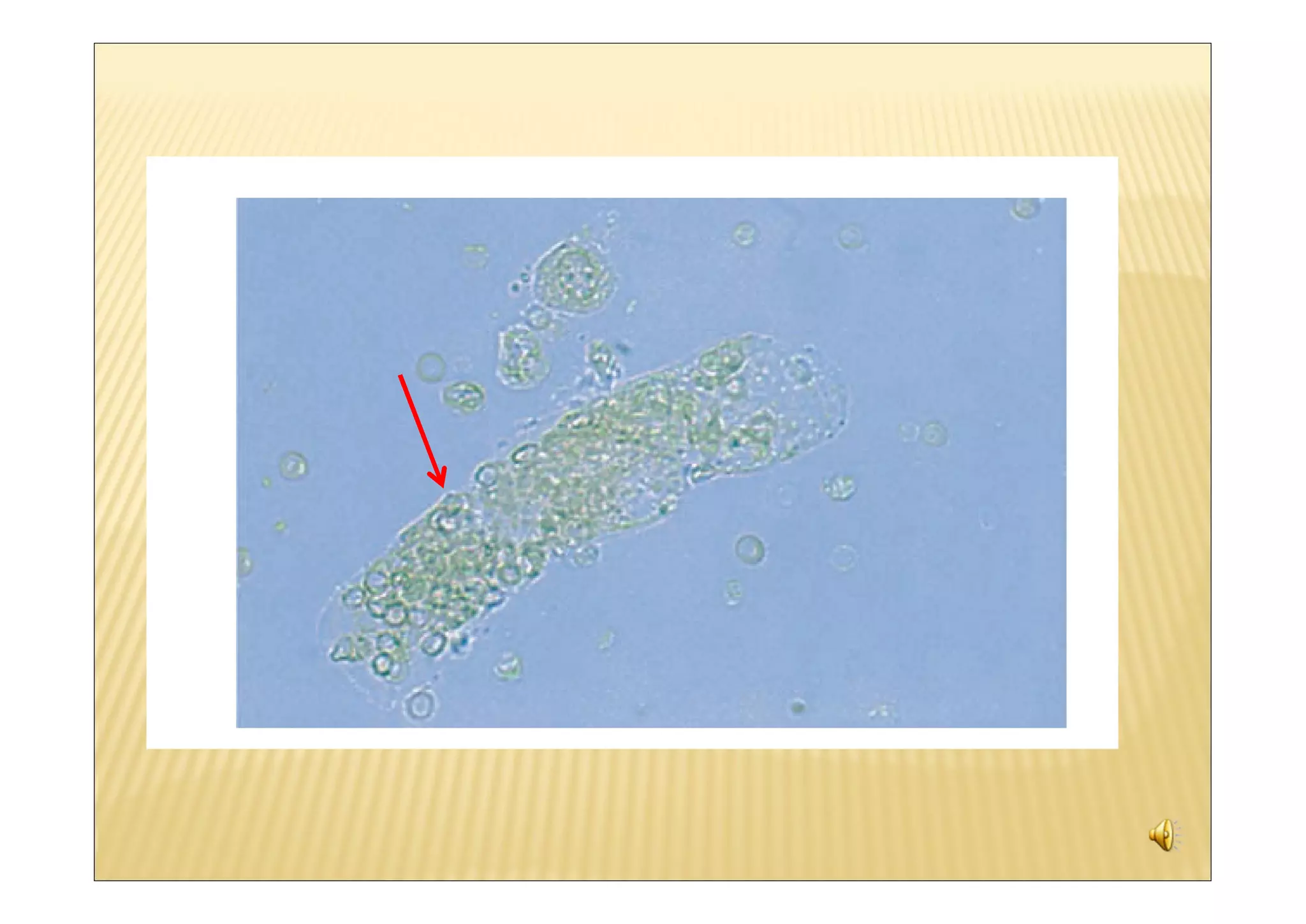 Urine casts | PDF