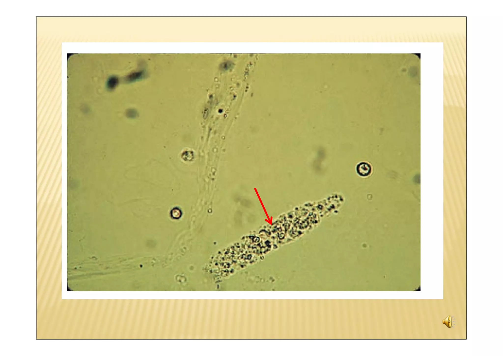 Urine casts | PDF