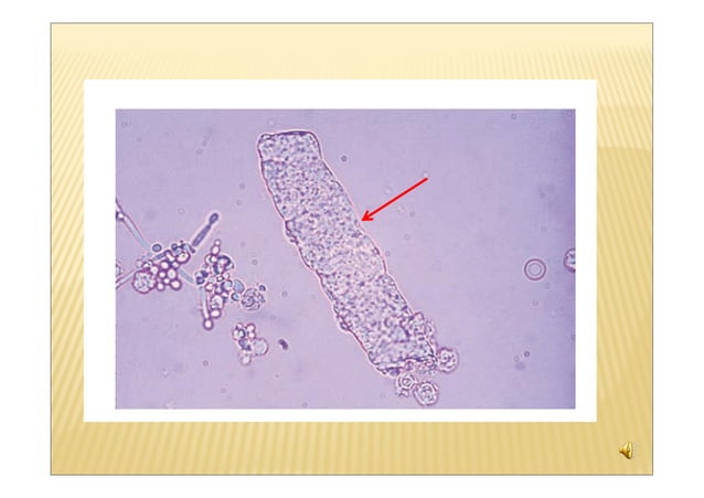 Urine casts | PDF