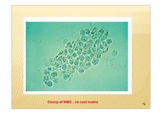 Wbc Casts In Urine