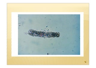 Fatty Casts In Urine