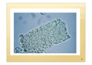 Broad Casts In Urine