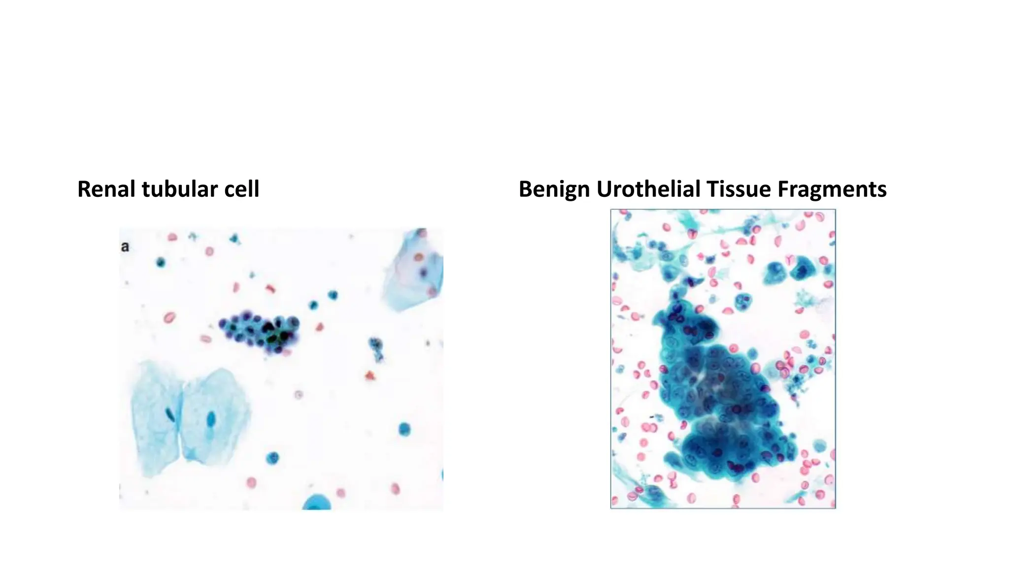 Urine cytology - Diagnostic Principles and Reporting.pptx