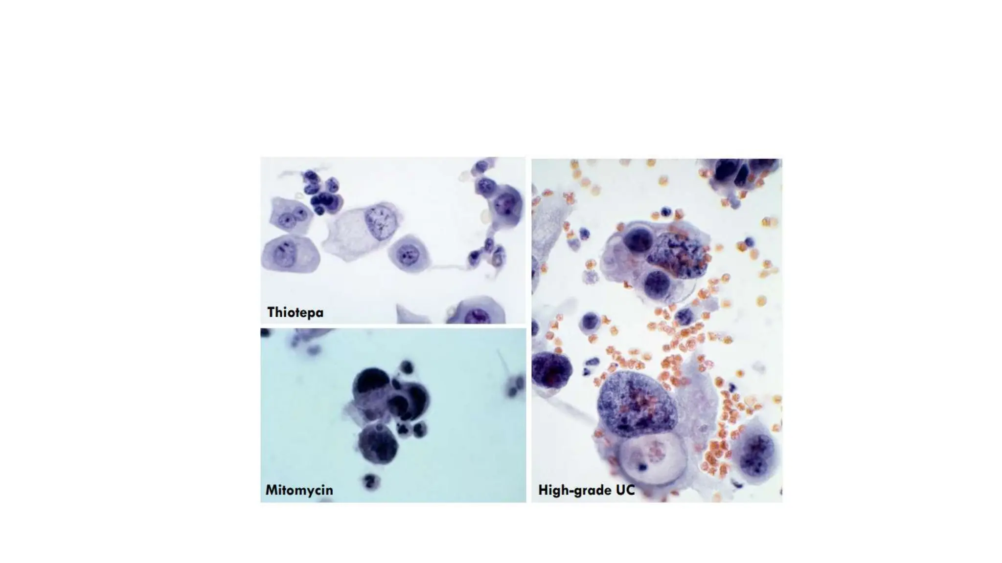 Urine cytology - Diagnostic Principles and Reporting.pptx