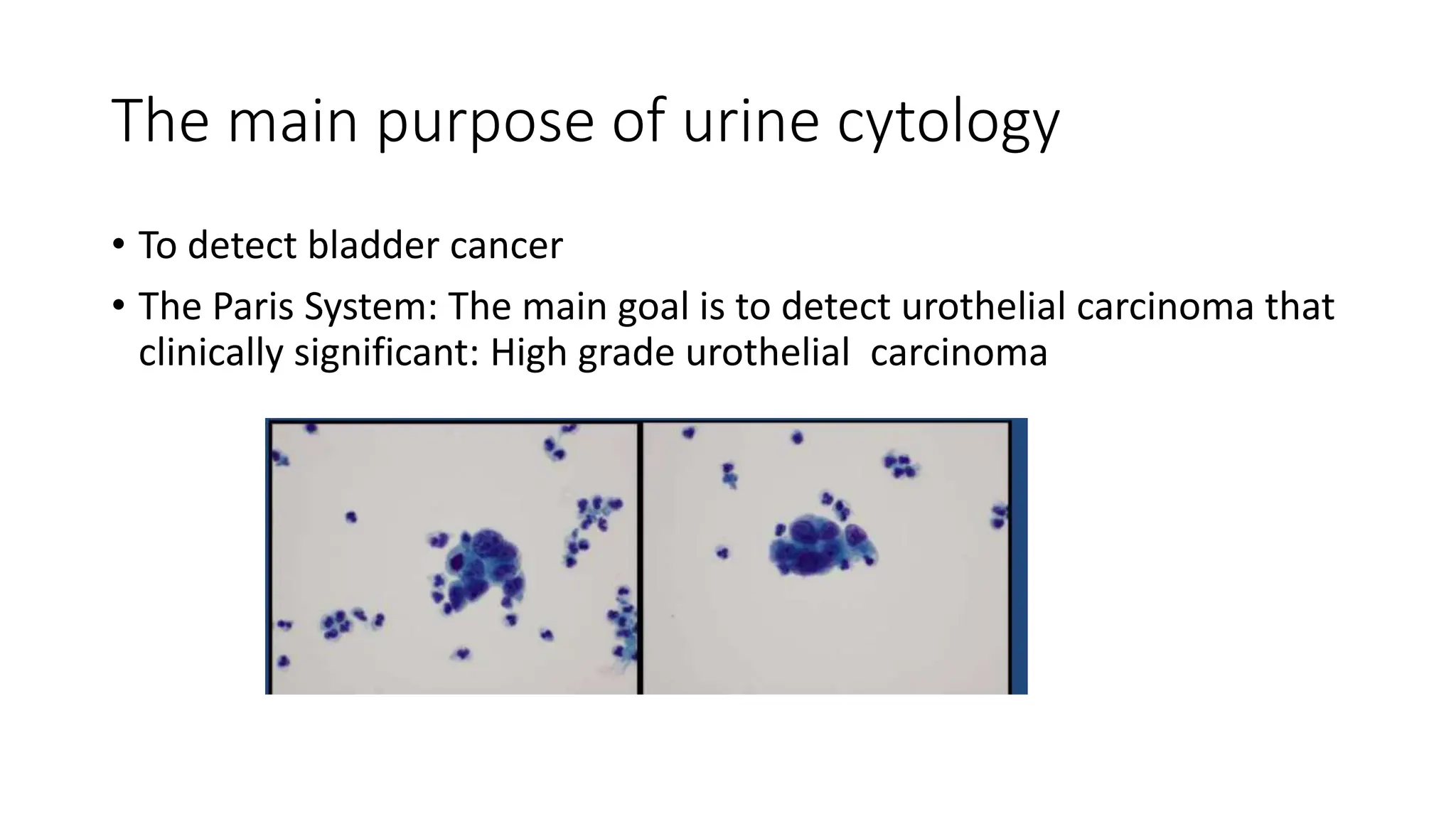 Urine cytology - Diagnostic Principles and Reporting.pptx
