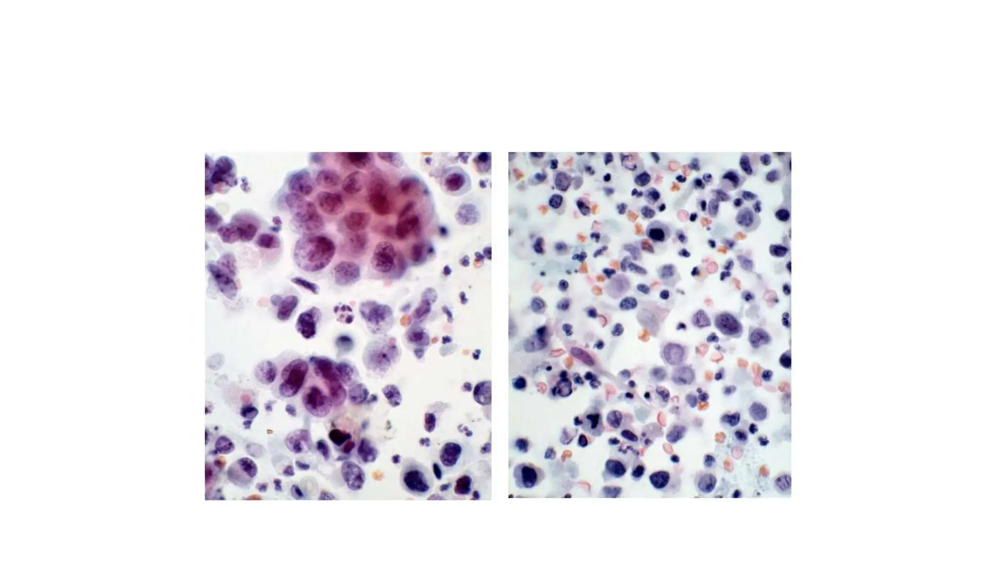Urine cytology - Diagnostic Principles and Reporting.pptx