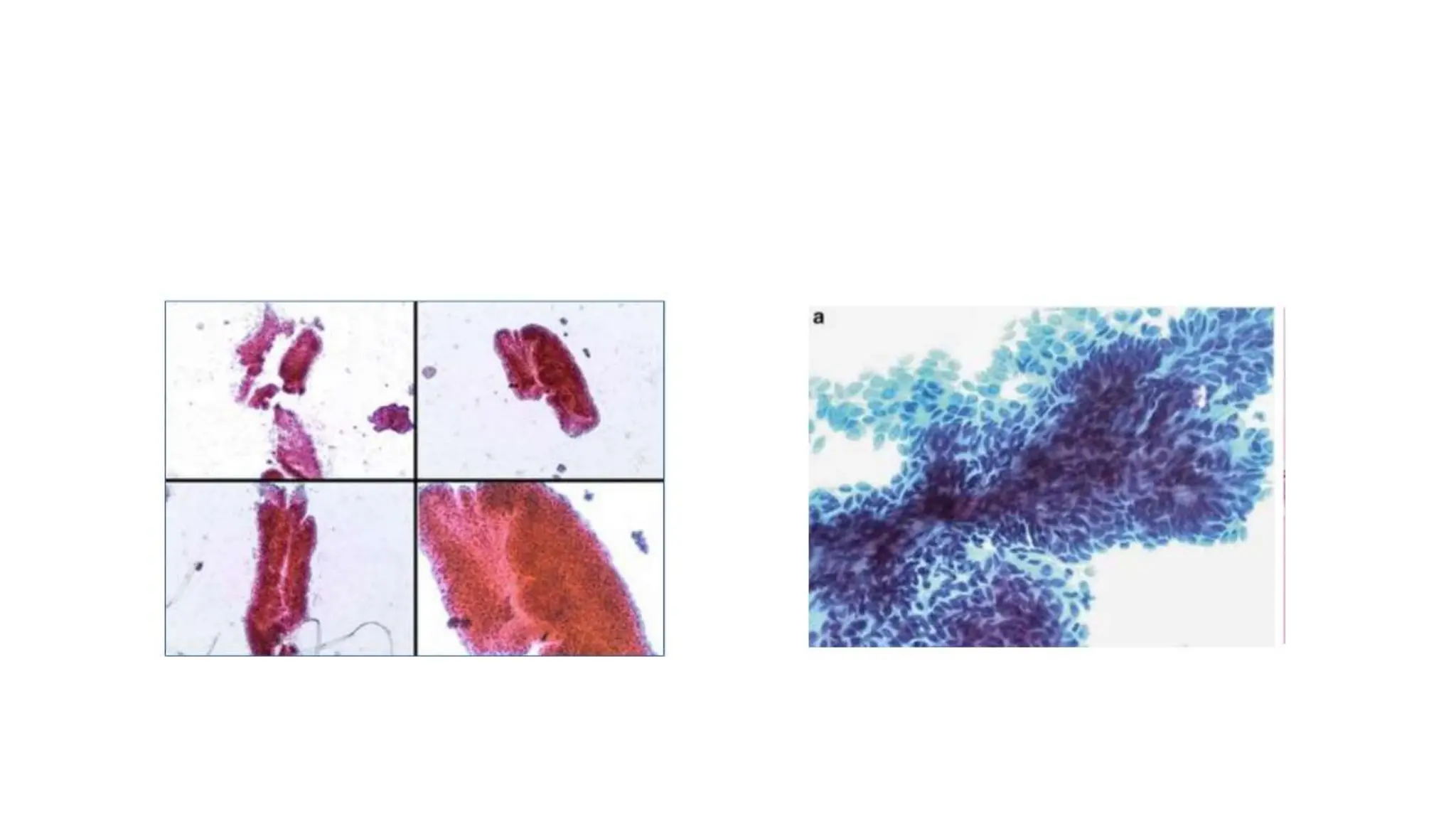 Urine cytology - Diagnostic Principles and Reporting.pptx