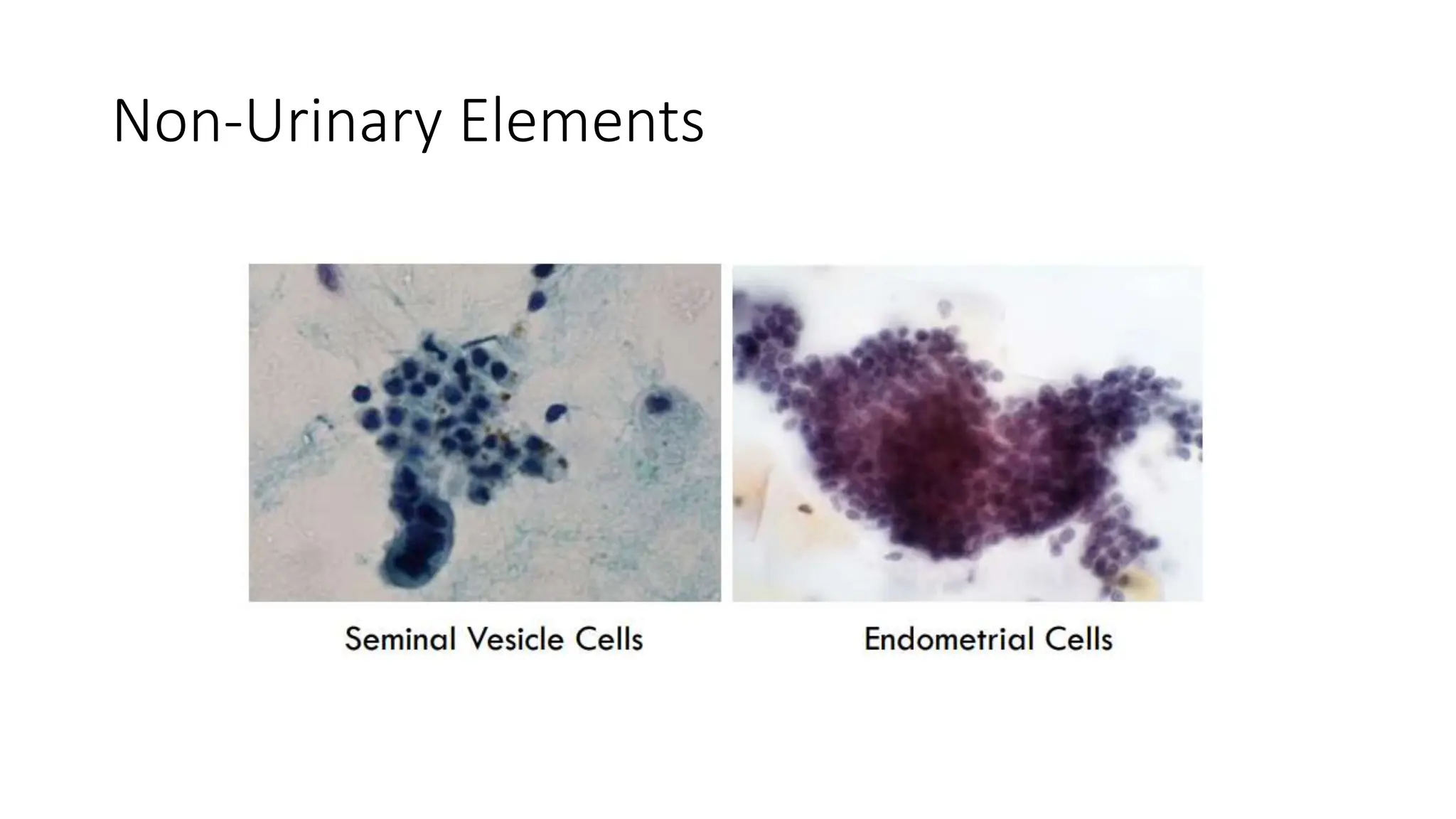 Urine cytology - Diagnostic Principles and Reporting.pptx