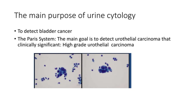 Urine cytology - Diagnostic Principles and Reporting.pptx