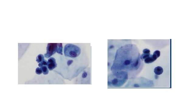 Urine cytology - Diagnostic Principles and Reporting.pptx