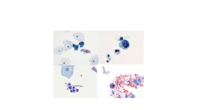 Urine cytology - Diagnostic Principles and Reporting.pptx