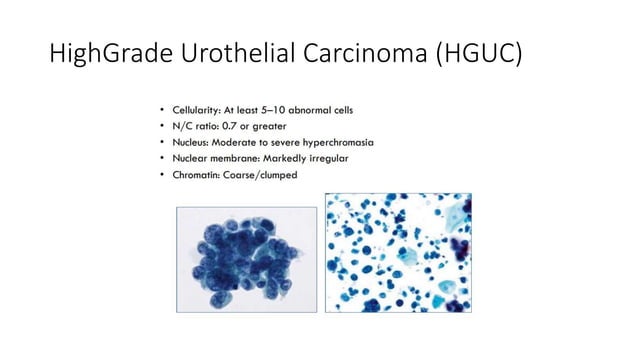 Urine cytology - Diagnostic Principles and Reporting.pptx