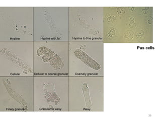 urine examination copy urine microscopy and physical findings.pptx