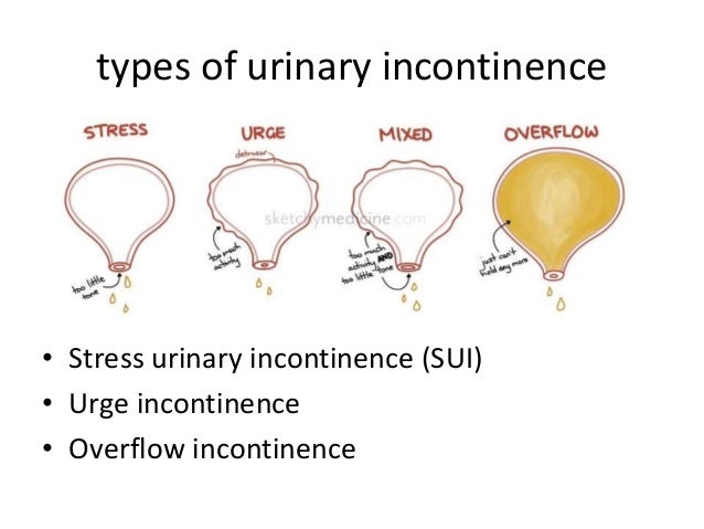 Overflow incontinence of urine icd 10 - sherytrainer