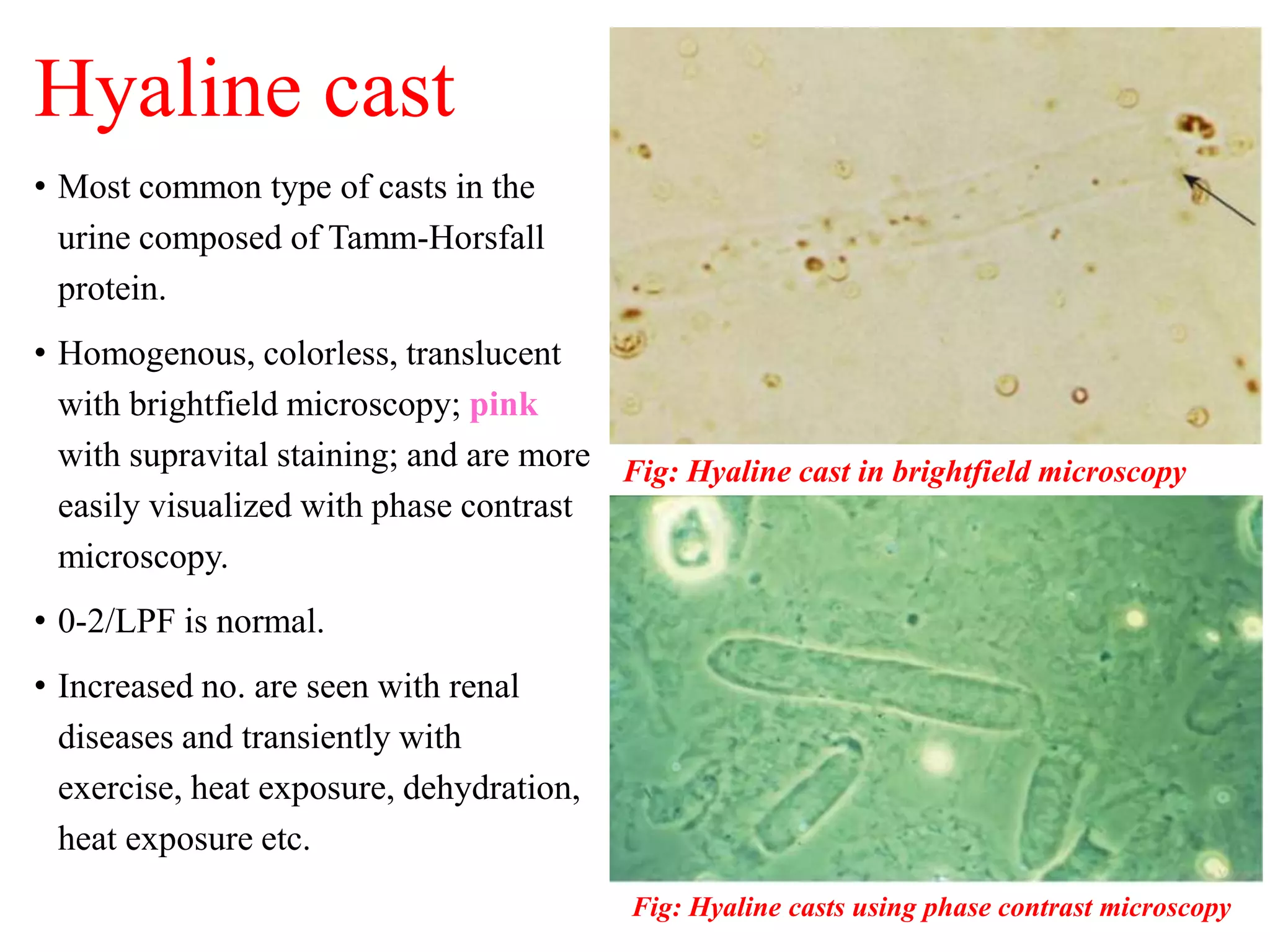 microscopic examination of urine and other special tests | PPTX