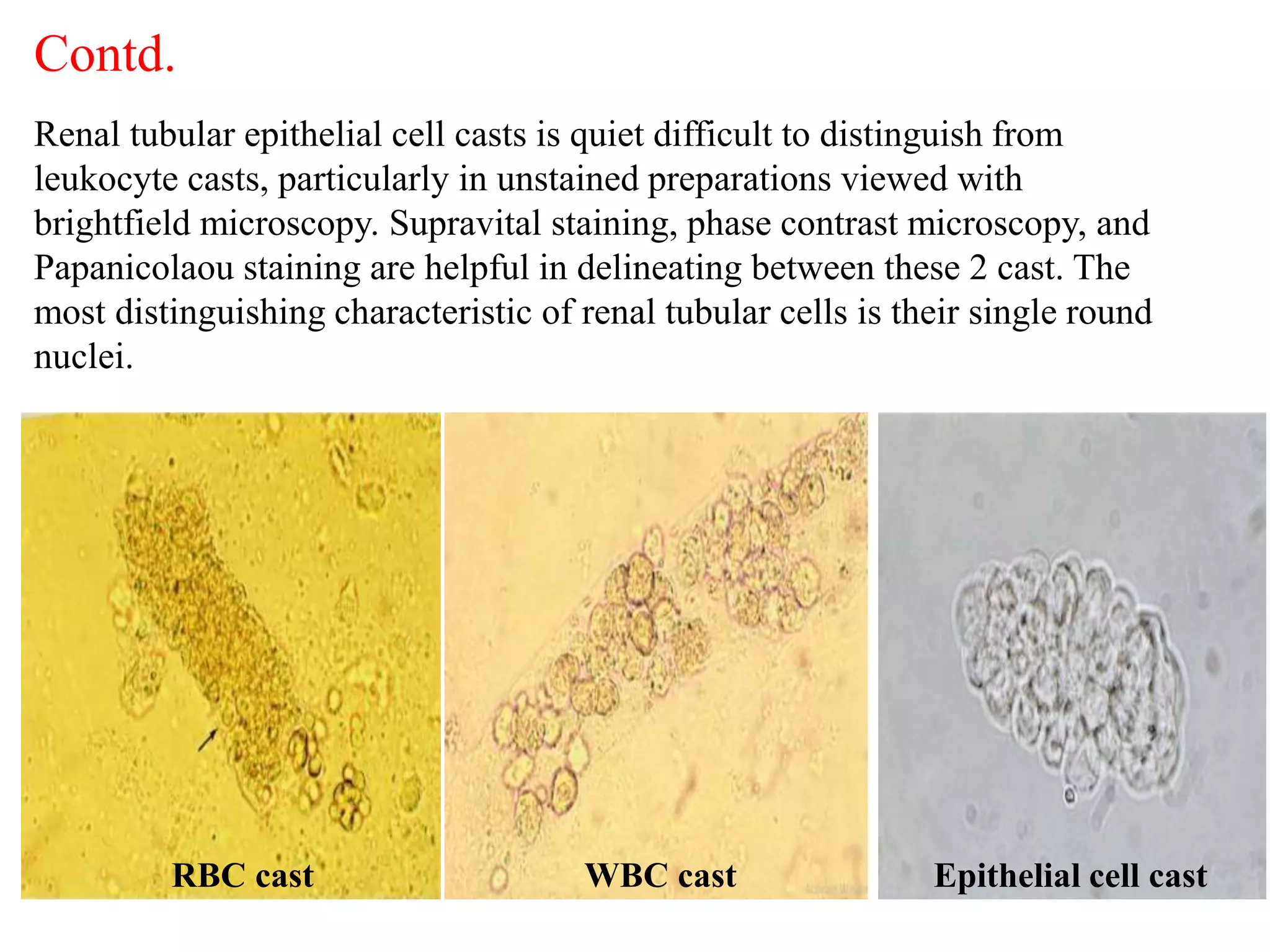 microscopic examination of urine and other special tests | PPTX